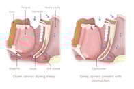 Difference Between APAP, BiPAP, CPAP, and ASV